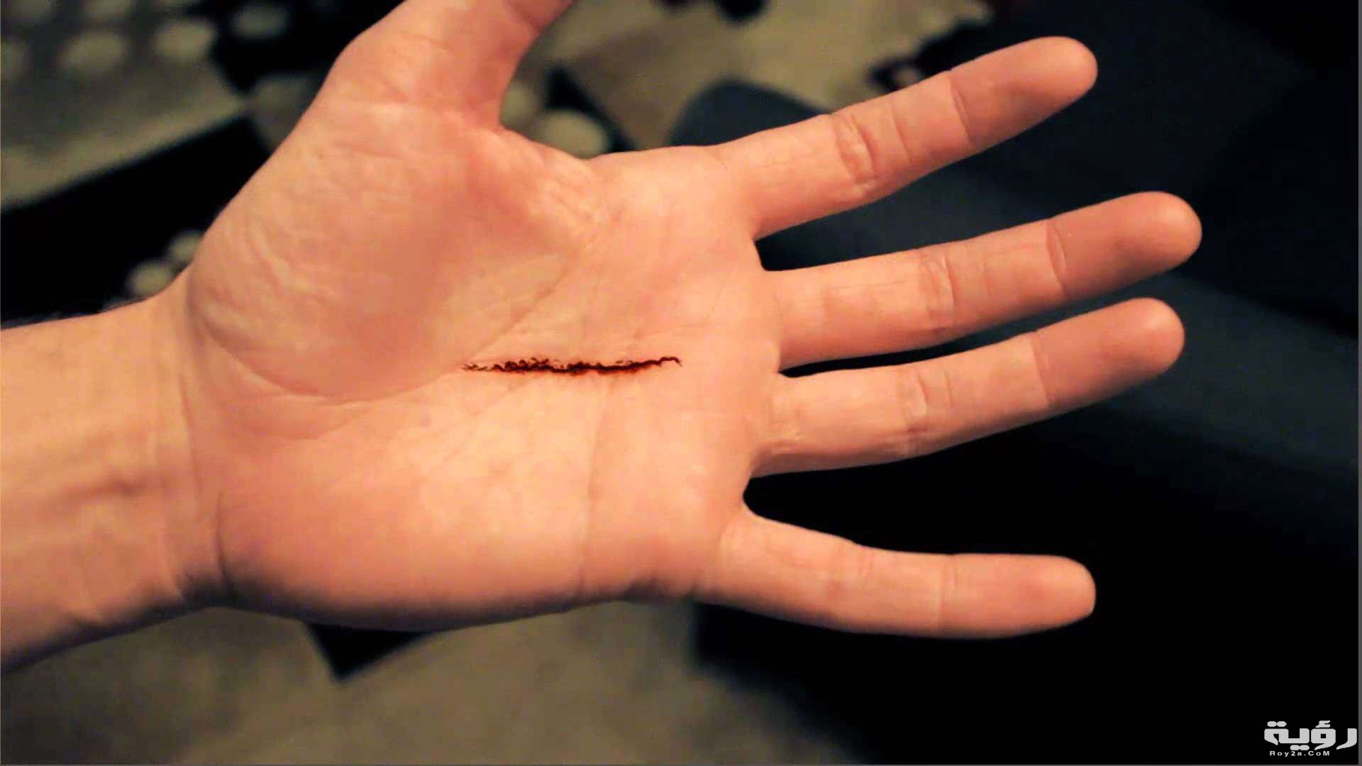 حلمت اني يدي مجروحة - موقع رؤية